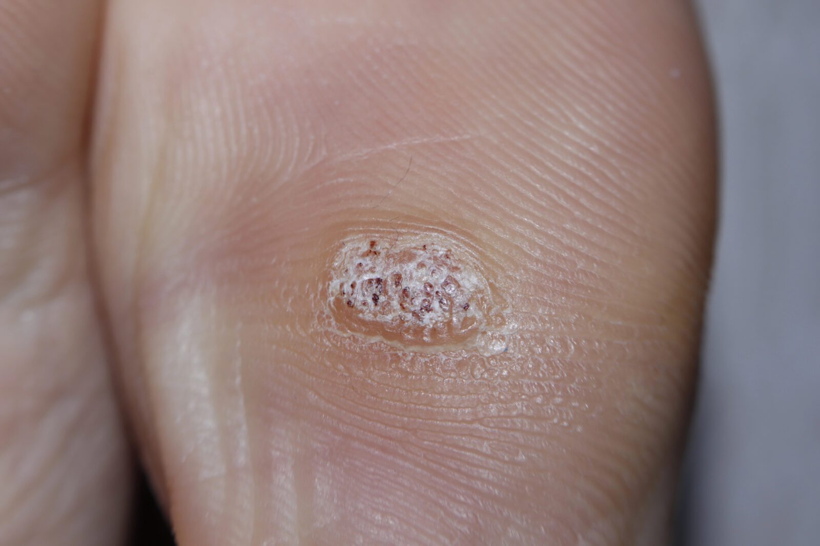 Wratten Behandeling - C & Co Medisch pedicure